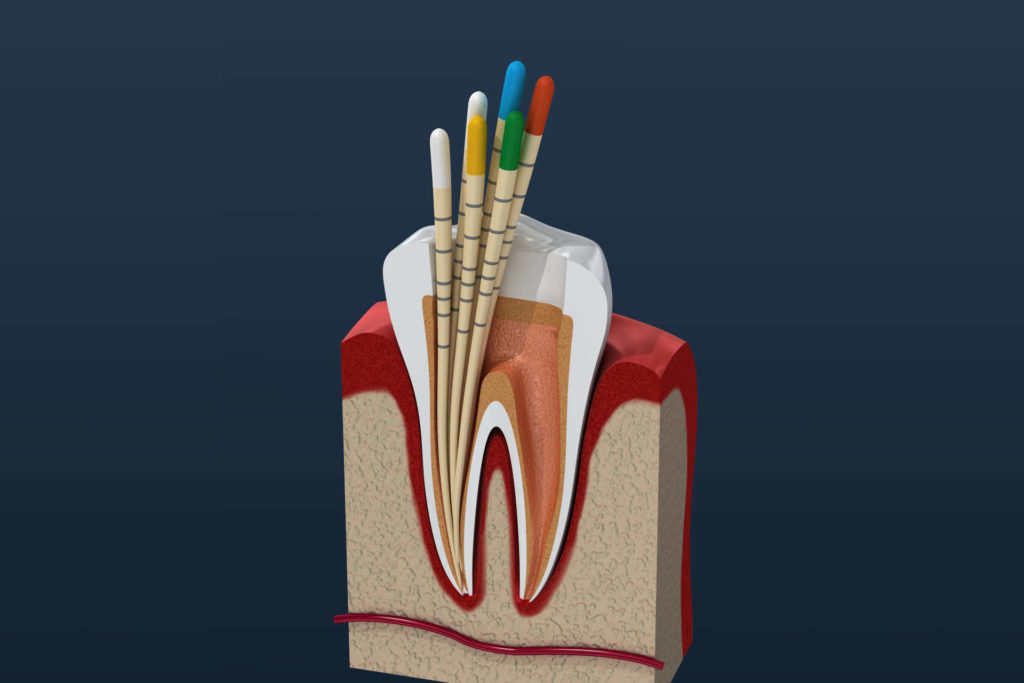 Endodoncy - Enzo Dental Clinic